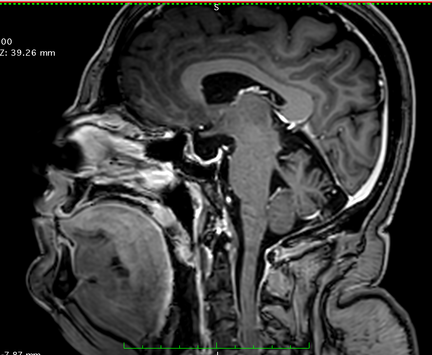 Περιστατικά - Brain & Spine Surgery